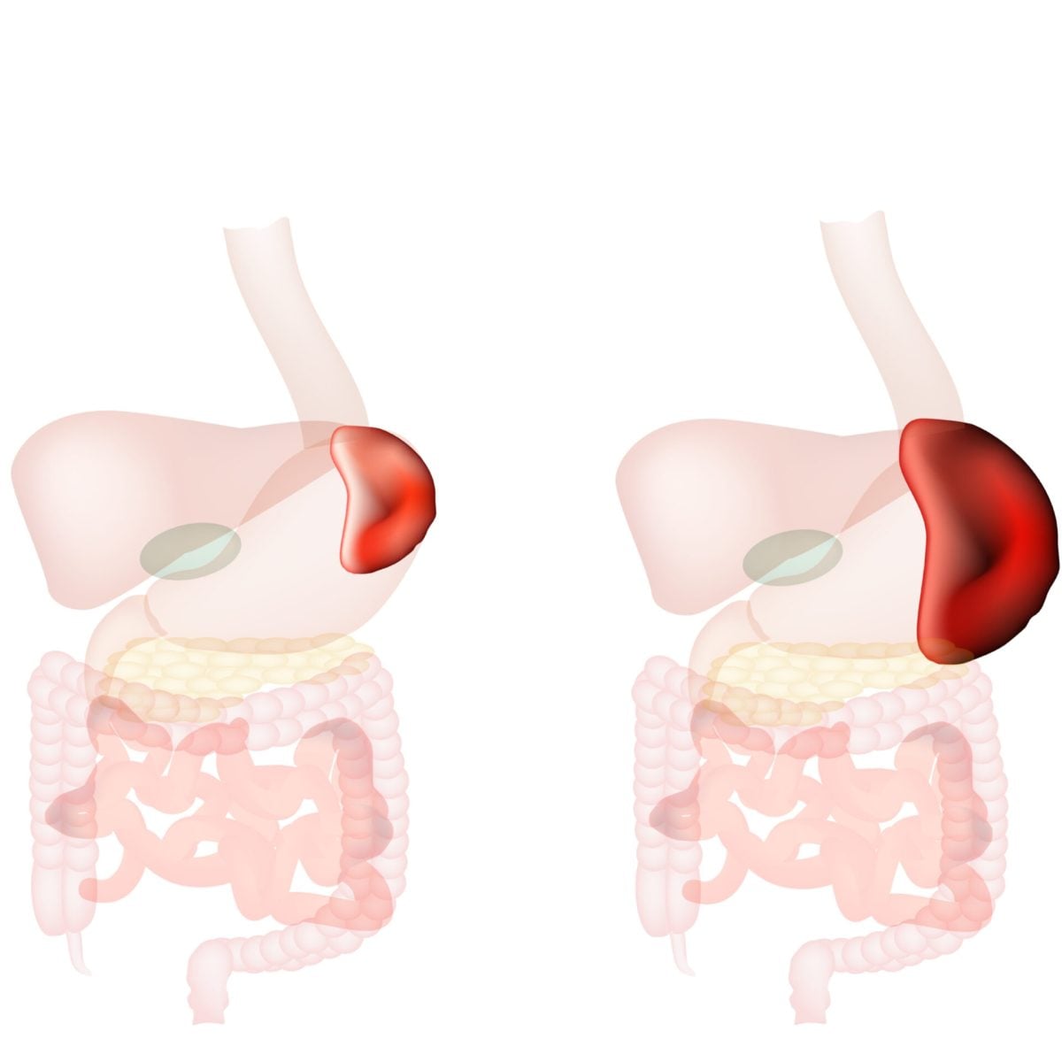 De ce apar durerile de splină și când este nevoie de operație