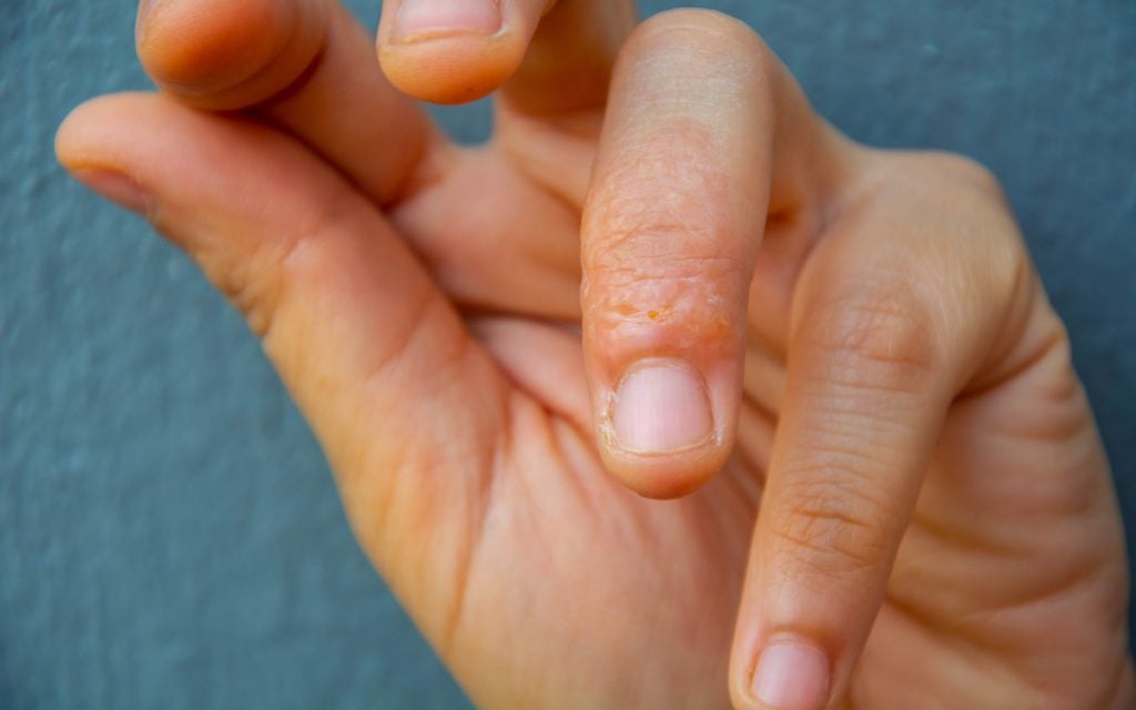 Eczema: tipuri, factori declanșatori și tratament eficient