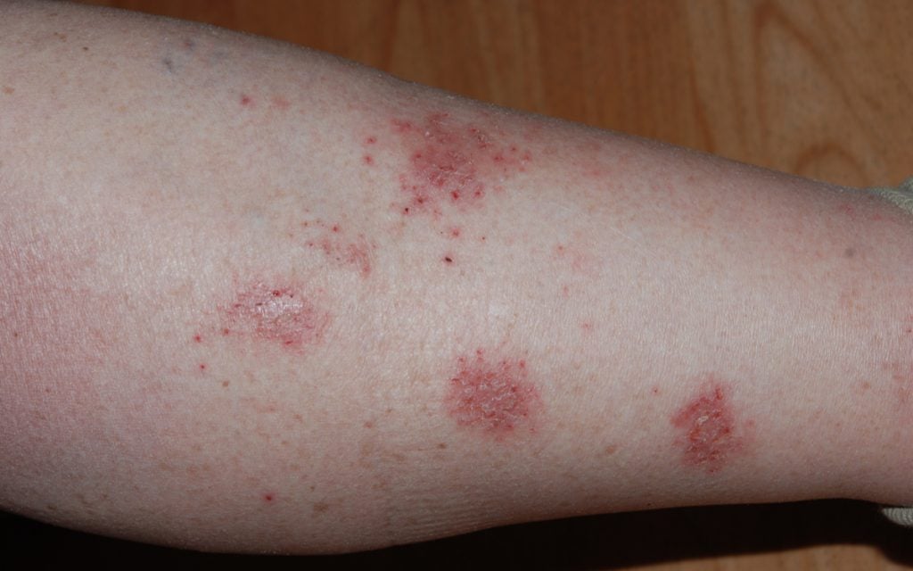 Eczema: tipuri, factori declanșatori și tratament eficient