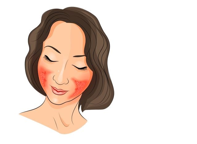 Cele mai eficiente tratamente pentru rozacee. Poze și sfaturi de la medic