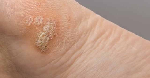 Negi: tipuri, cauze, tratamente eficiente și prevenție