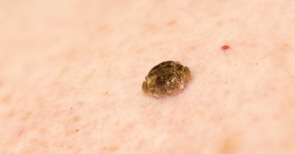 Negi: tipuri, cauze, tratamente eficiente și prevenție