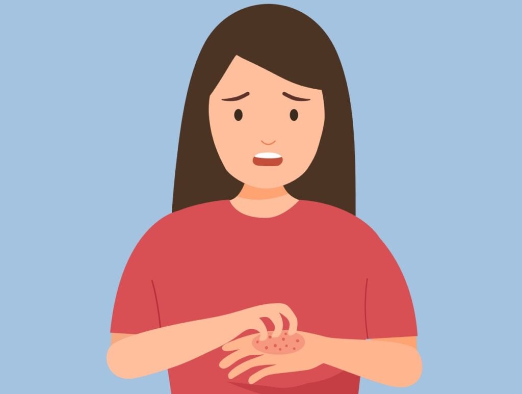 Dishidroza: de ce apare și cum poate fi ținută sub control